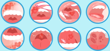 MUCOSITIS ORAL | Genially