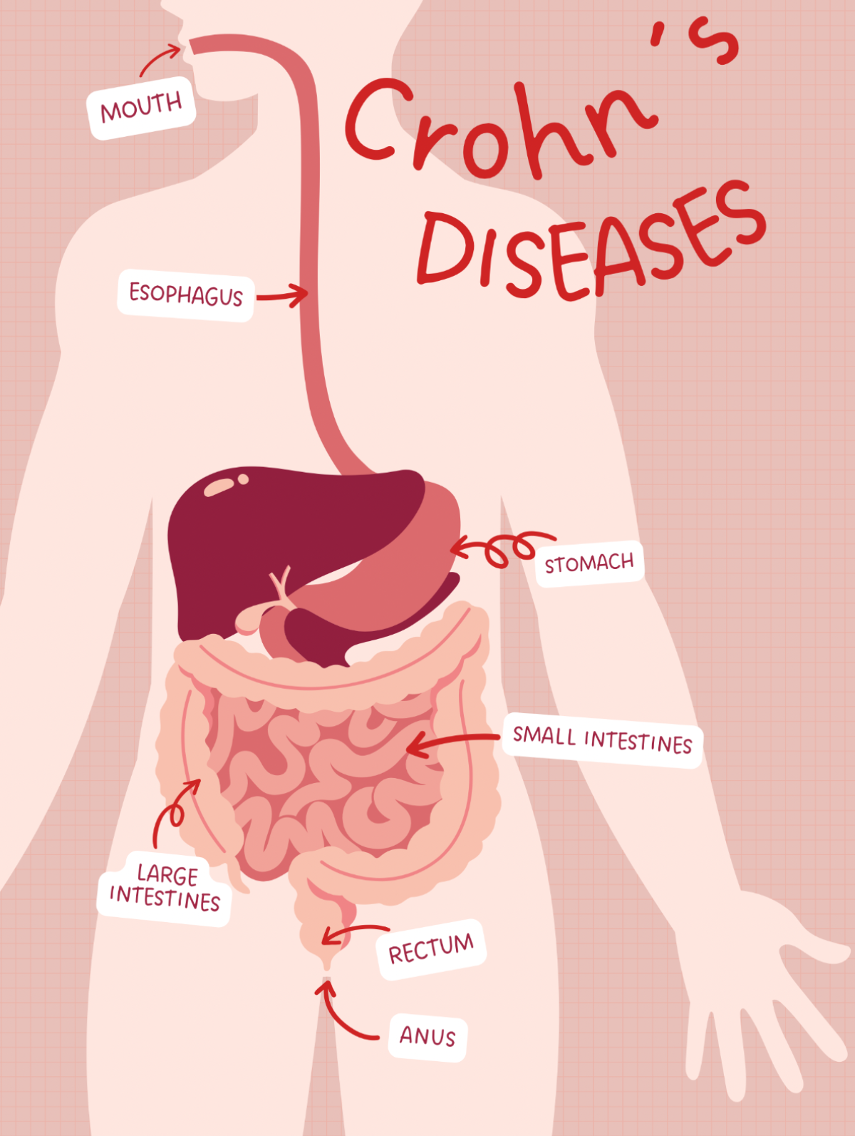 Crohn ´s disease | Genially