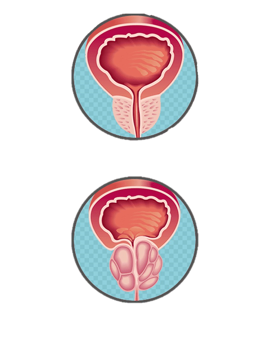 INFOGRAFÍA DE LOS TIPOS DE PROSTATITIS | Genially