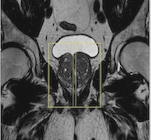 prostata RM | Genially