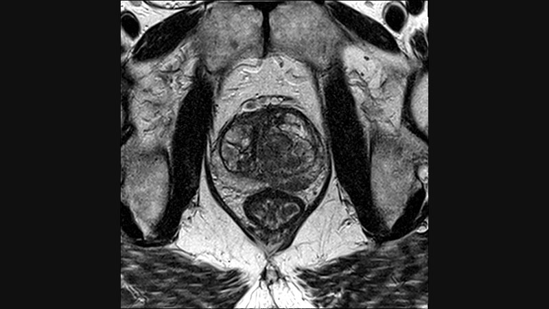 prostata RM | Genially