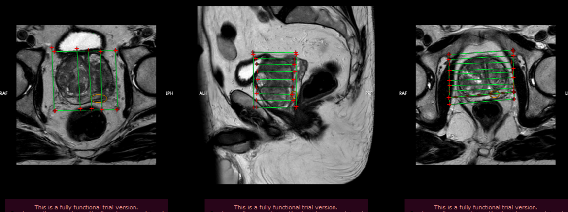 prostata RM | Genially