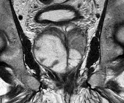 prostata RM | Genially