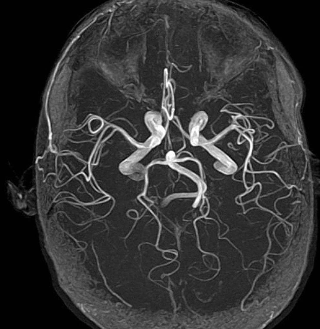 ANGIO RM POLIGONO DE WILLIS | Genially