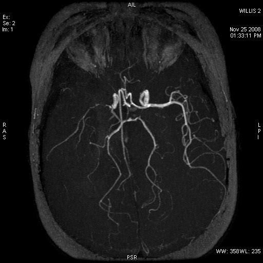 ANGIO RM POLIGONO DE WILLIS | Genially