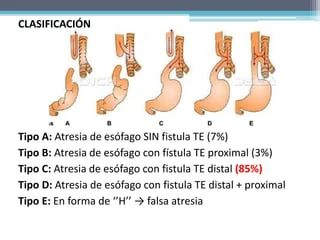 Infografia Atresia Esofágica | Genially