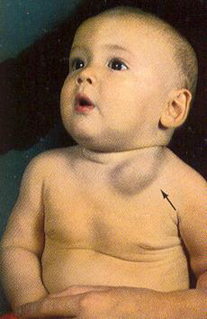 Anomalías desarrollo estructuras del Arco faríngeo | Genially