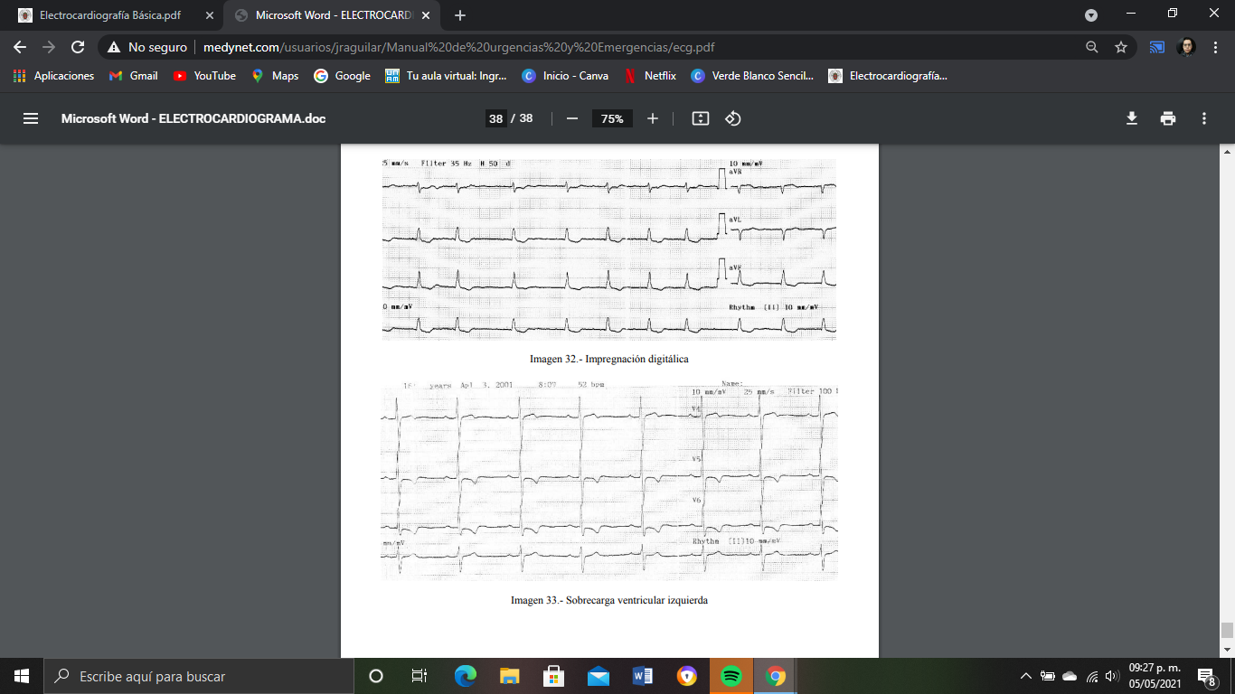 Electrocardiograma | Genially
