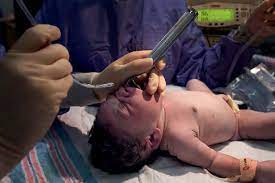 RCP neonatal | Genially