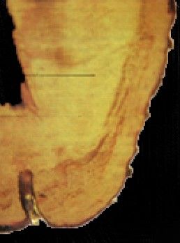 Cemento Radicular - Biología Bucal | Genially
