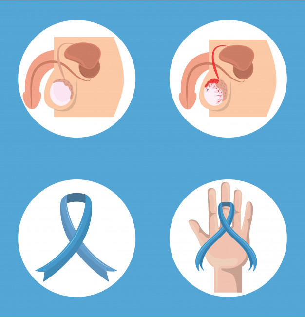 CÁNCER DE PRÓSTATA | Genially