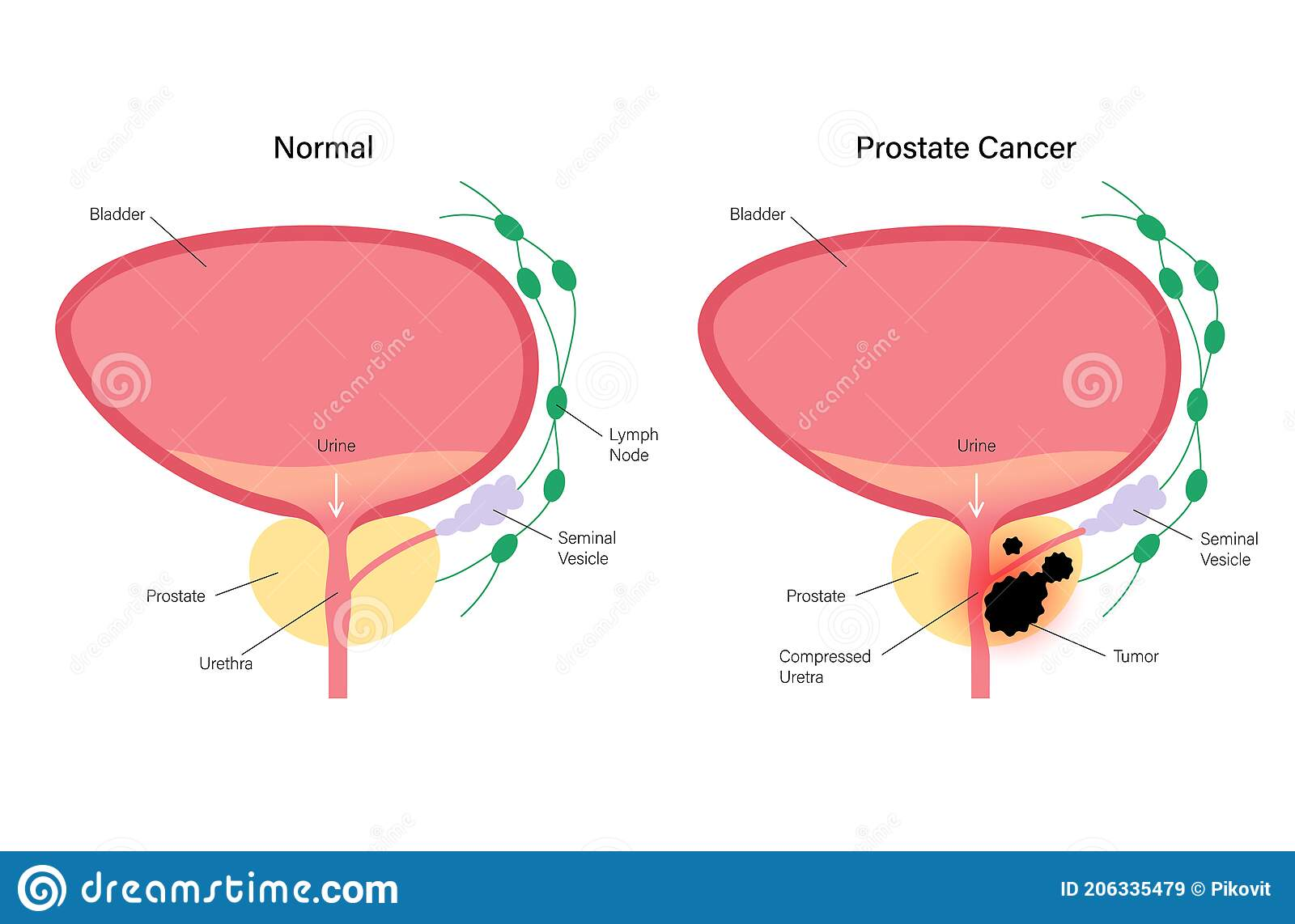 CÁNCER DE PRÓSTATA | Genially