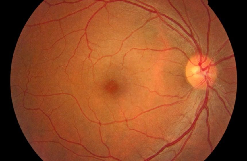 Exploración de fondo de ojo | Genially