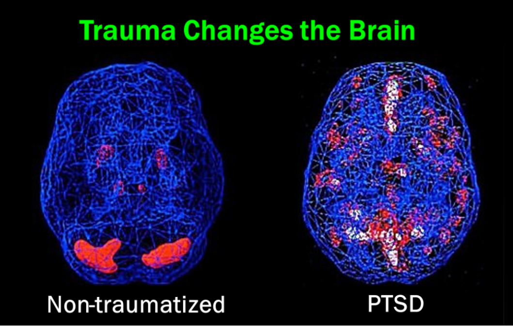 Trauma Changes the Brain | Genially