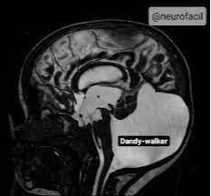 Sindrome Dandy Walker