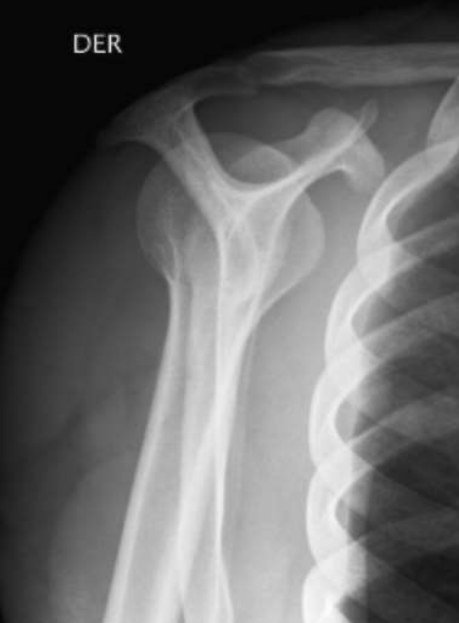 RX Hombro Outlet | Genially