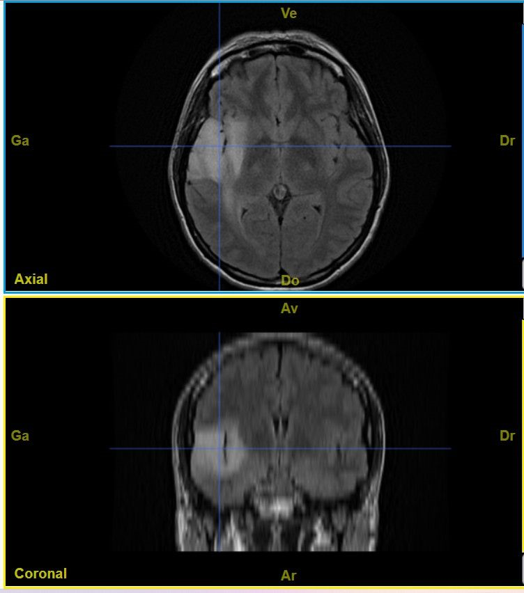 svt-Marie-IRM | Genially