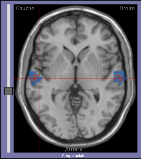 svt-Marie-IRM | Genially
