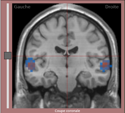 svt-Marie-IRM | Genially